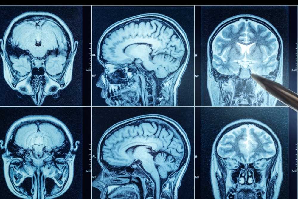 Effects of Overdose and Brain Damage | WhiteSands Treatment