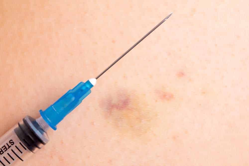 Track Marks on Arm: Causes and Treatment | WhiteSands Rehab